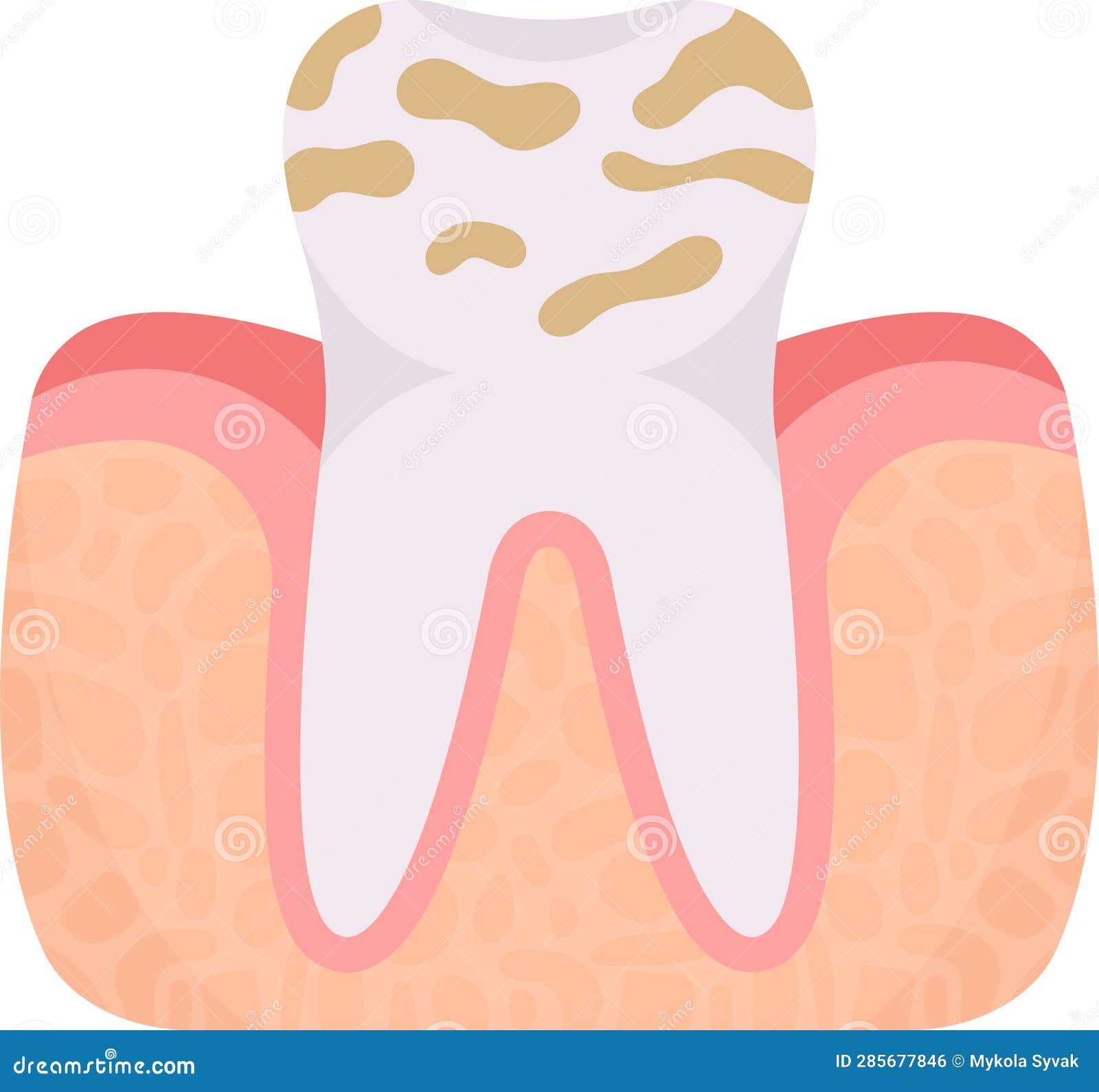 Dental Plaque Tooth Problem Stock Vector - Illustration of plaque ...