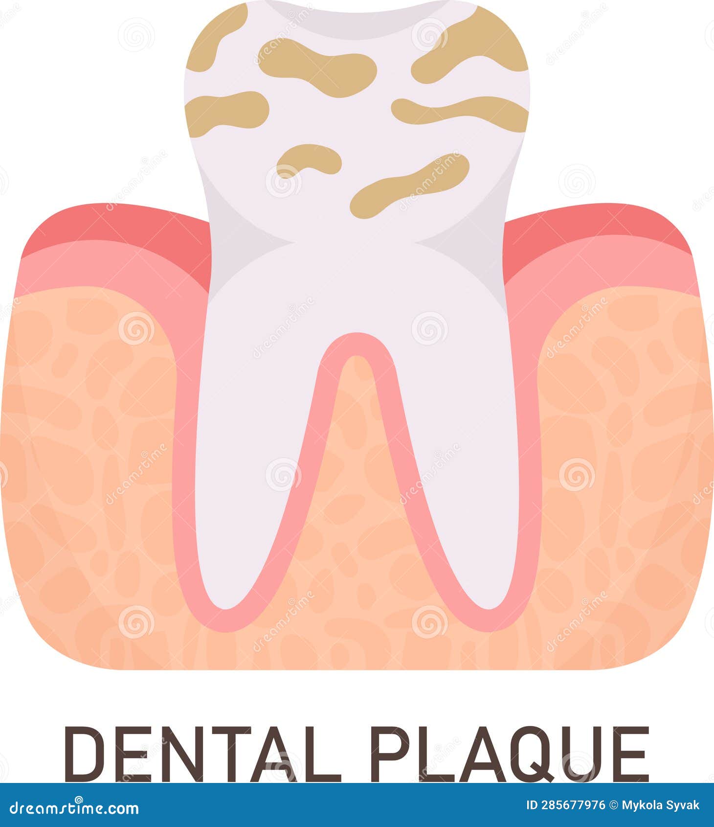 Plaque Tooth Icon - Tartar Tooth Icon Vector Illustration ...