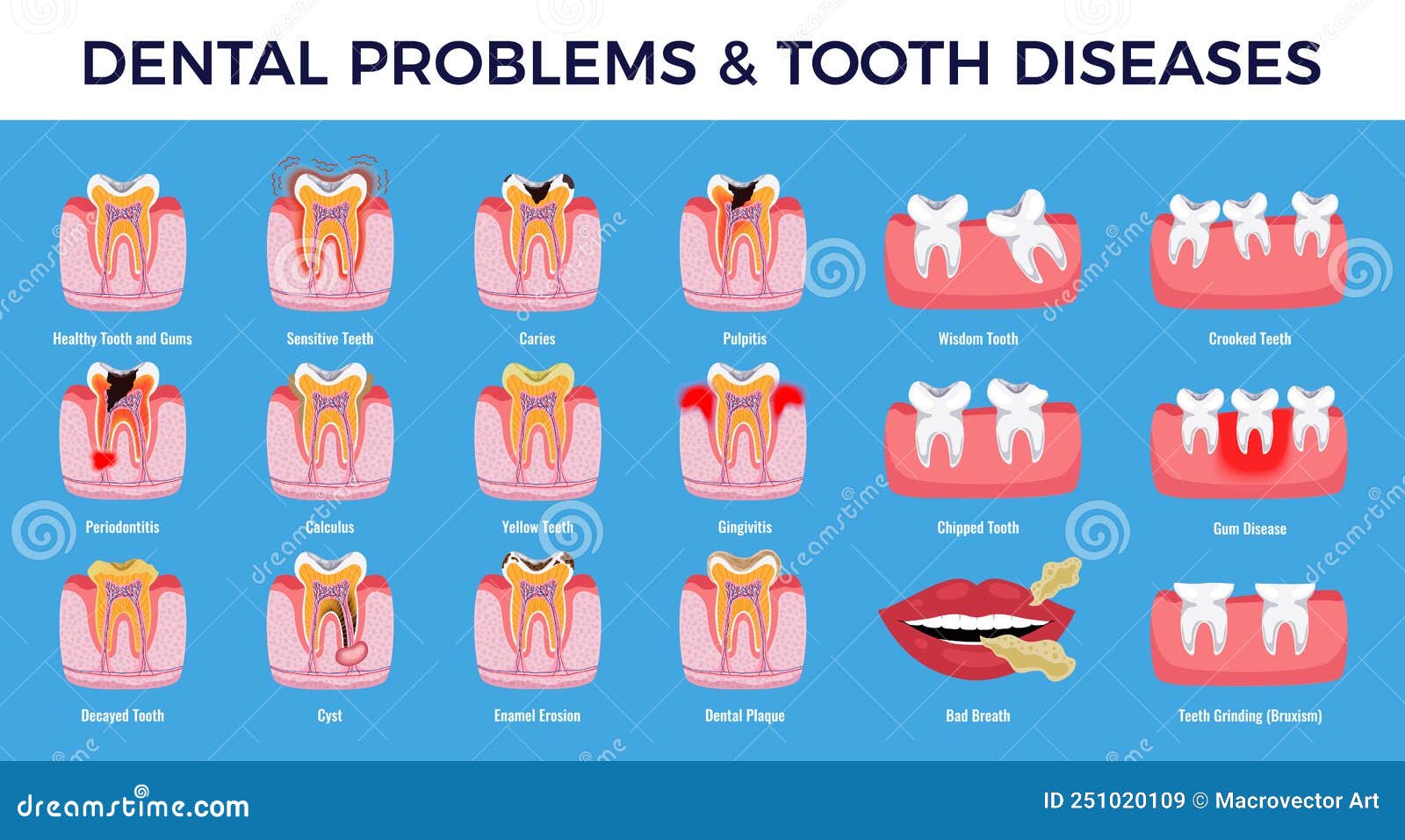 Dental Problems Diseases Infographic Set Stock Vector - Illustration of ...