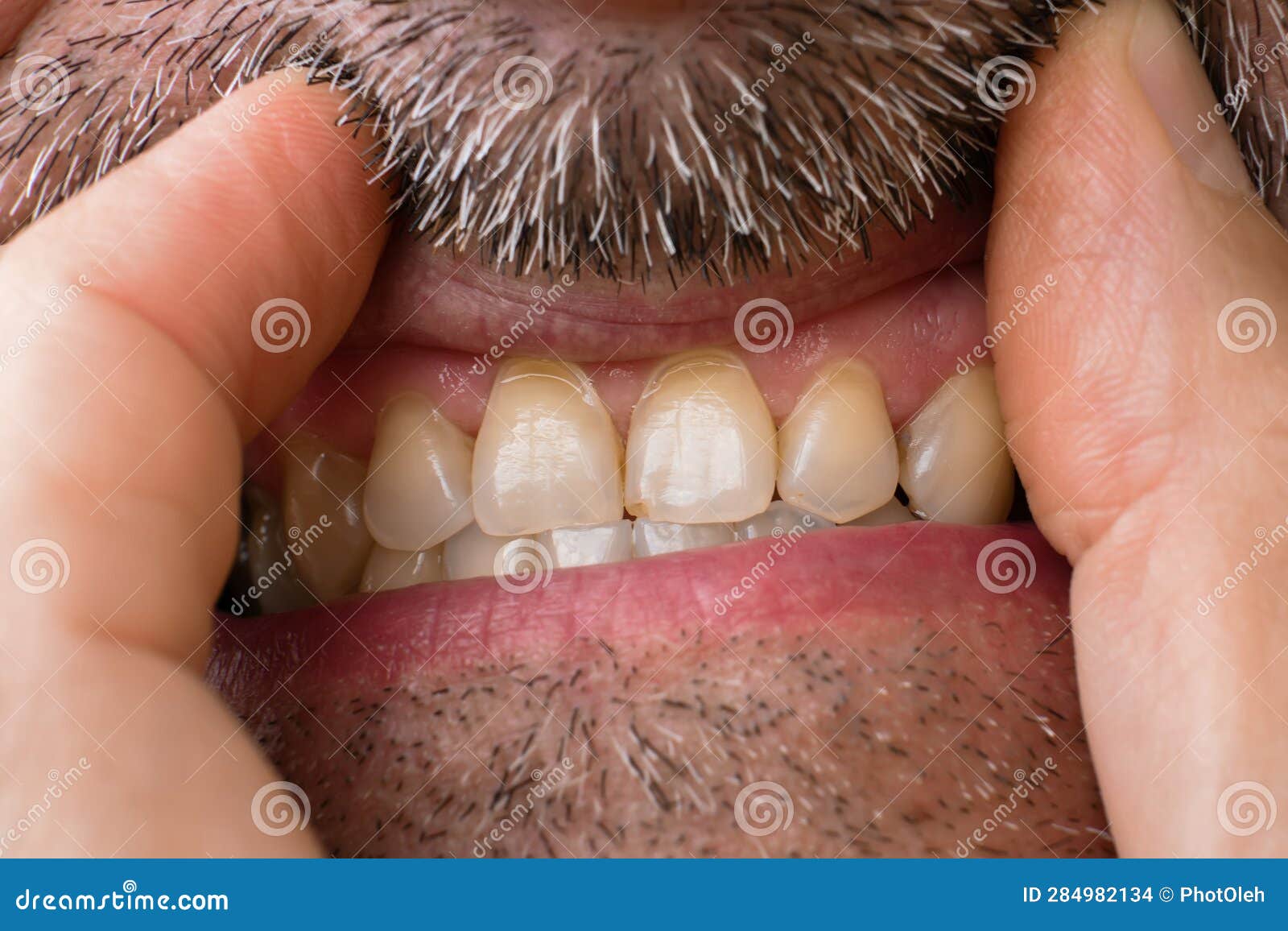 Dental Problems with Front Teeth in Middle Aged Man Stock Photo - Image ...