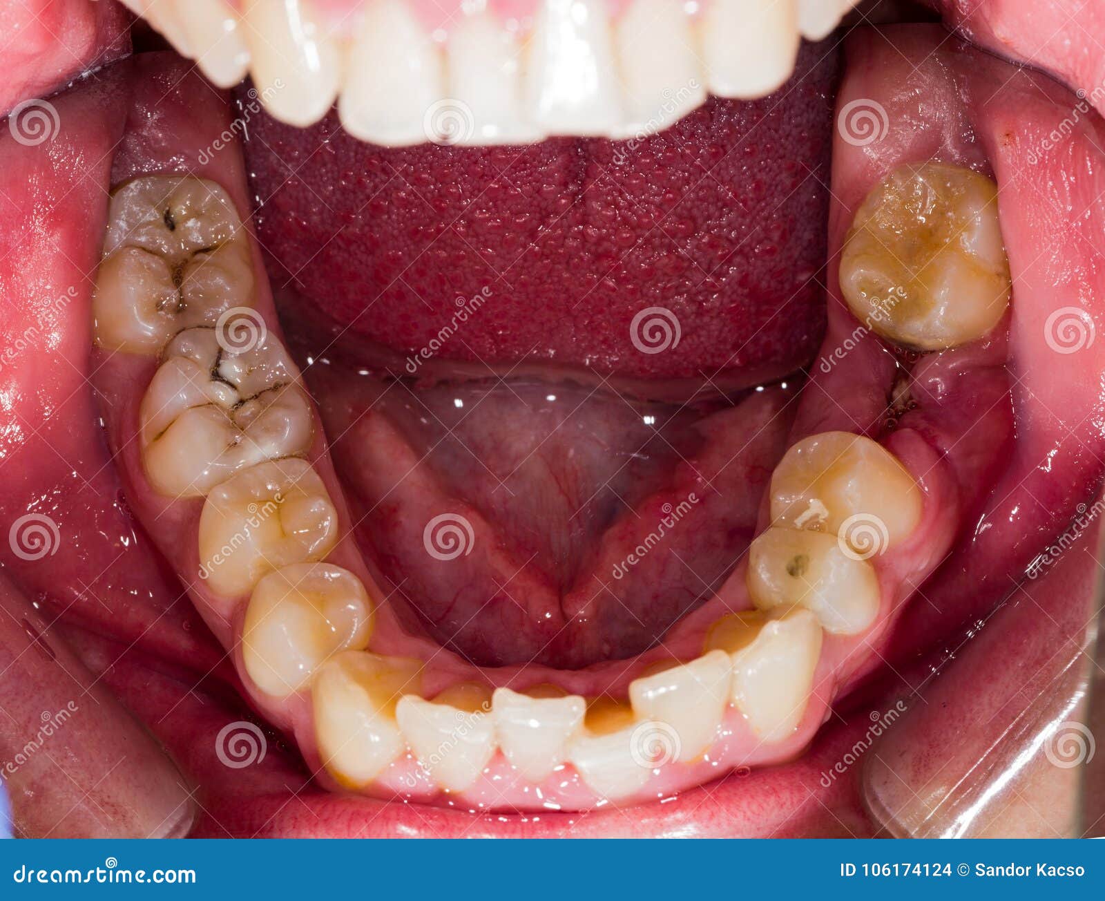 Decaying human teeth stock photo. Image of treatment - 106174124