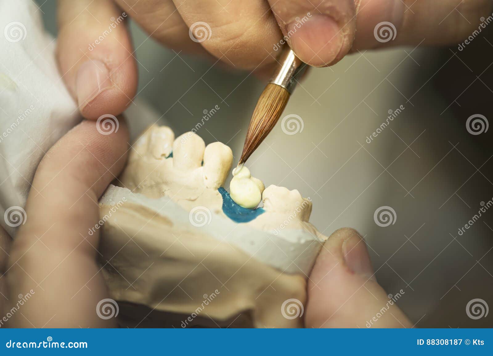 Dental Prosthesis stock image. Image of bite, clinic - 88308187