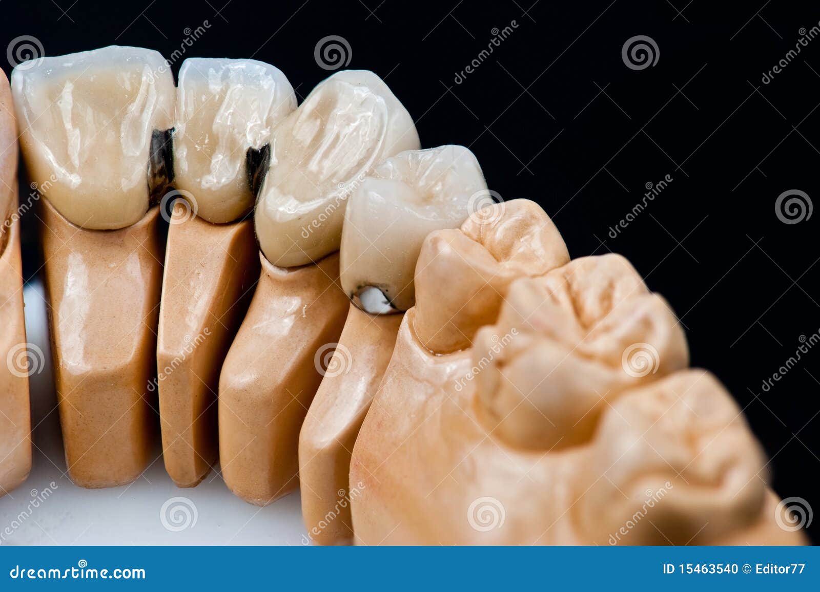 Dental Prosthesis Model with Implanted Teeth Stock Photo - Image of ...