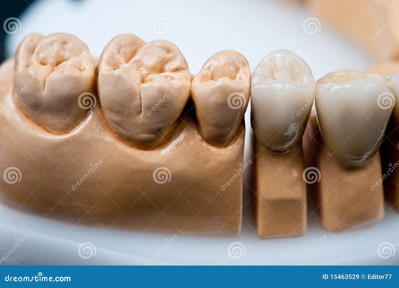 Dental Prosthesis Model for Teeth Stock Image - Image of white, crown ...