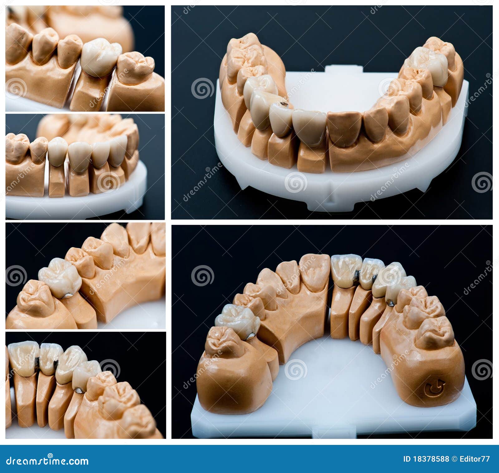 Dental Prosthesis, Dentures, Prosthetics Work. Prosthetics Hands While ...