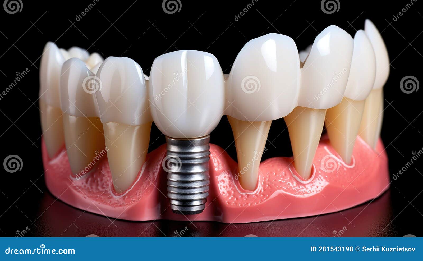 Dental Prosthesis, Tooth Implant, Mockup on a Black Background, Isolate ...