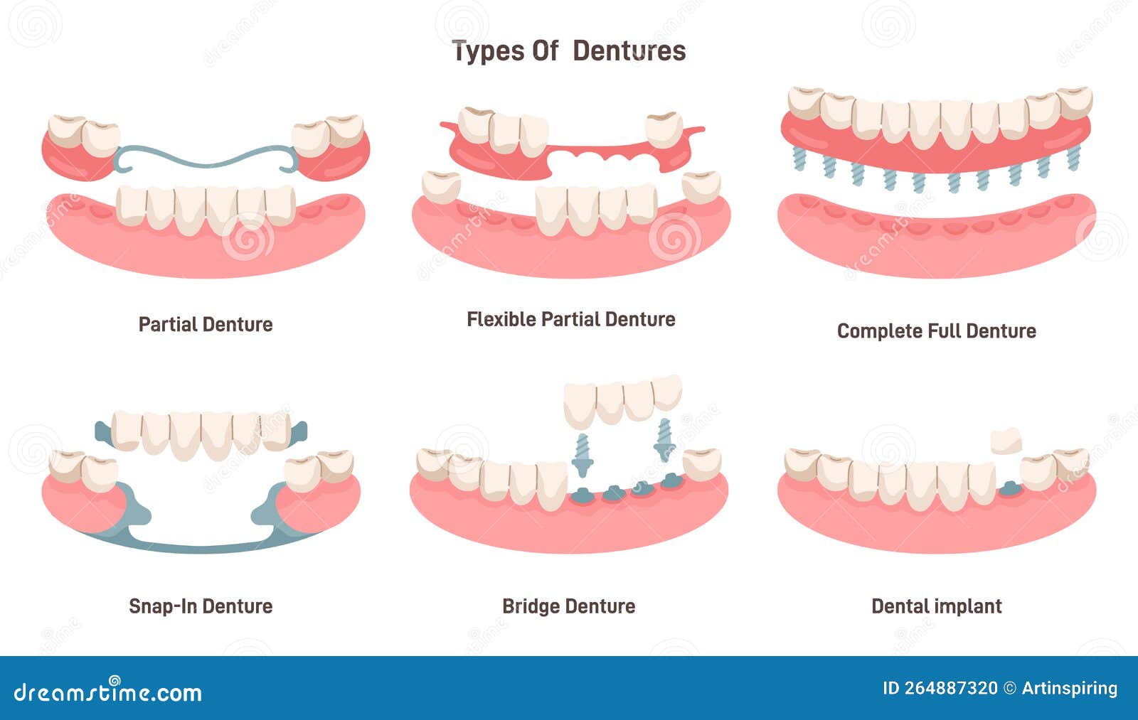 Dental Prosthesis Types Set. Dental Implant, Partial, Snap-in, Bridge ...