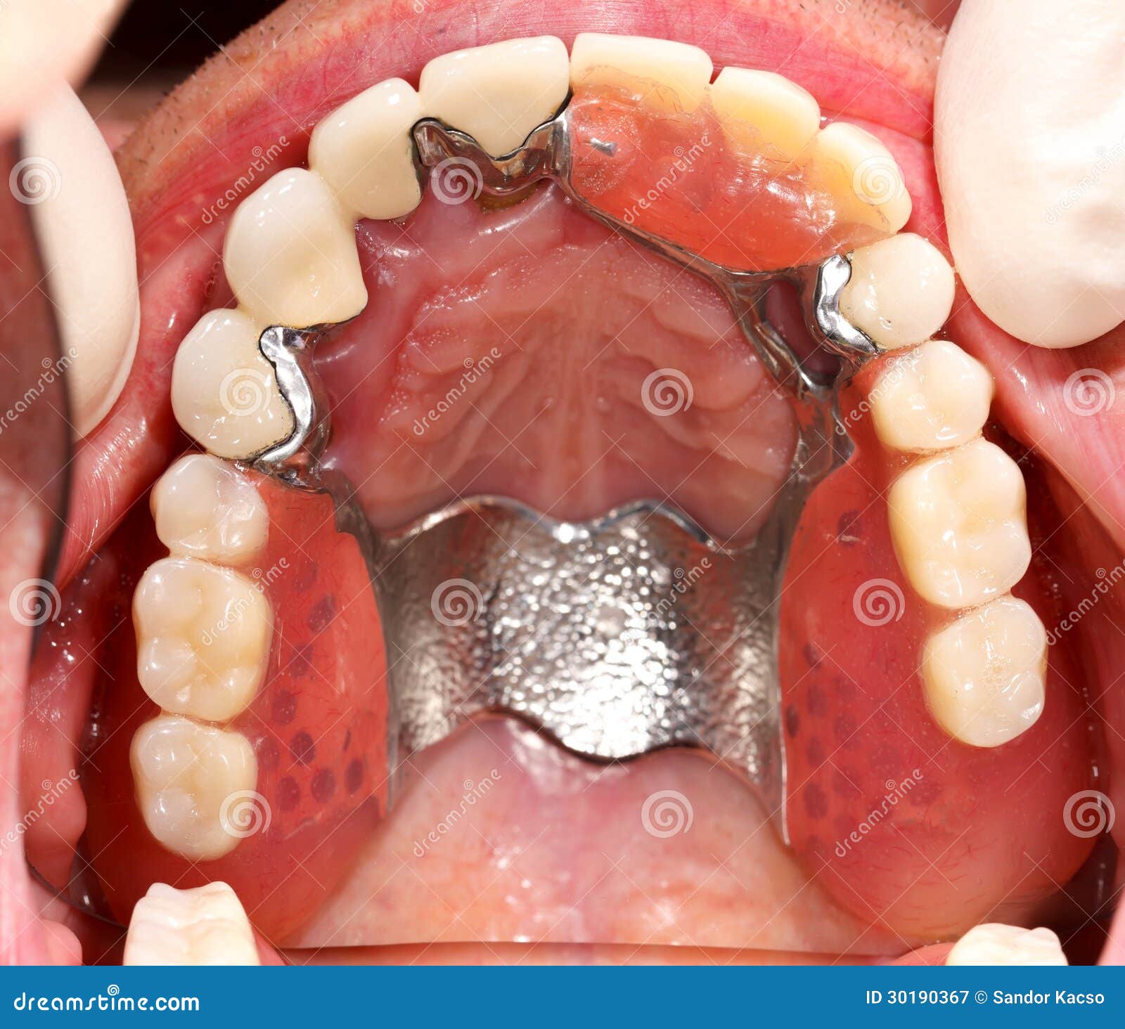 Upper Prosthesis in Mouth stock image. Image of patient - 30190367
