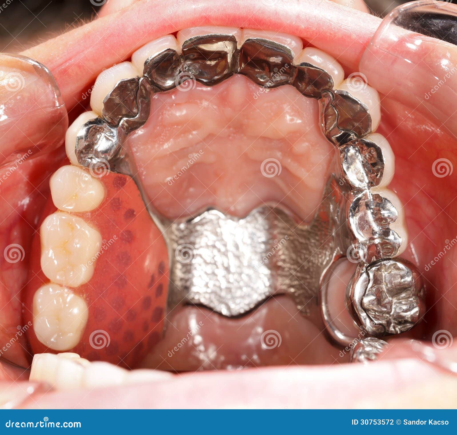 Dental Prosthetics stock photo. Image of health, prosthetics - 30753572