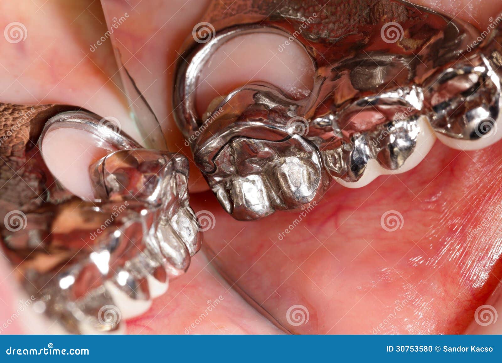 Dental Prosthetics stock photo. Image of prosthetics - 30753580