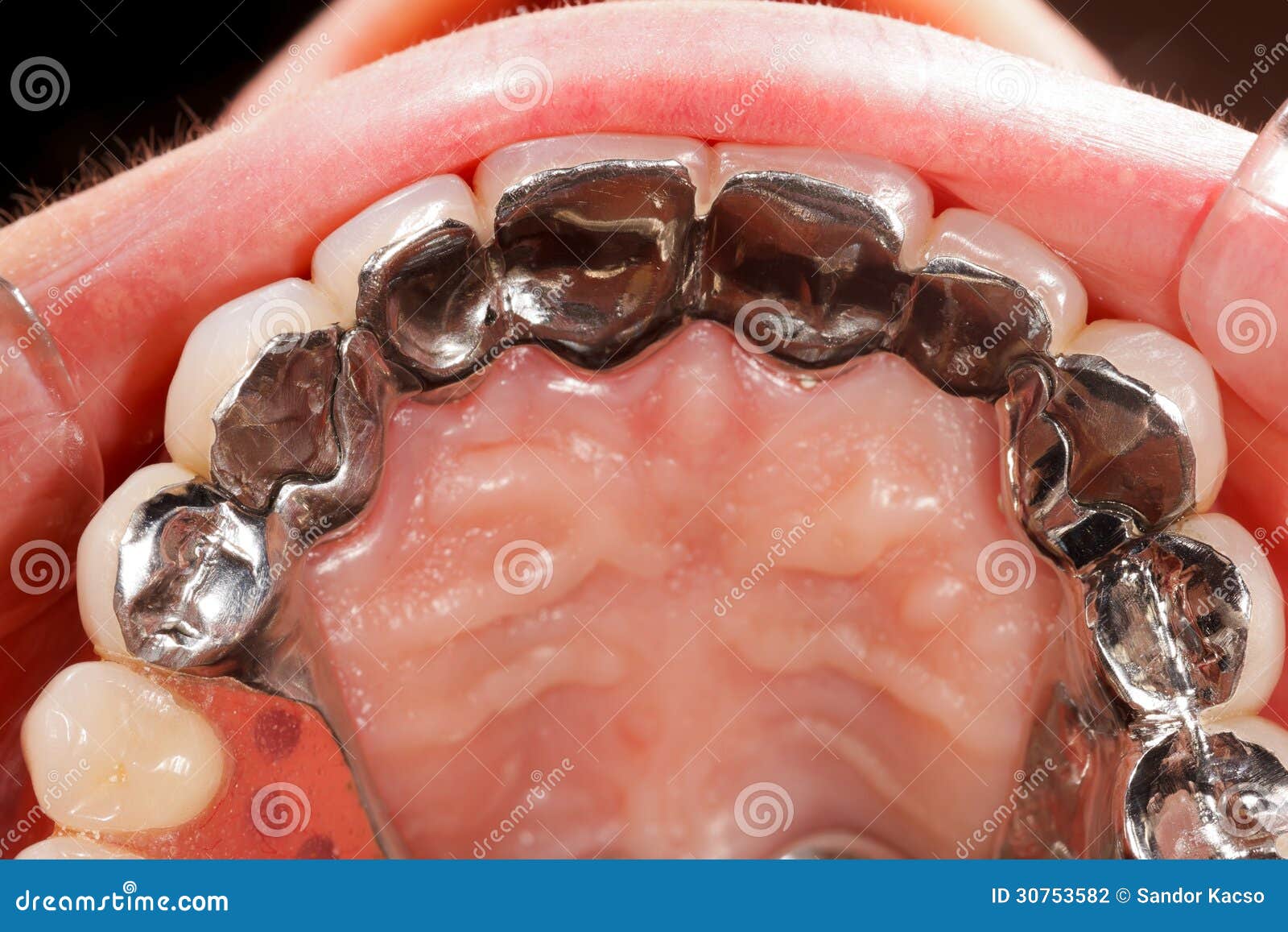 Dental Prosthetics stock photo. Image of products, dentist - 30753582