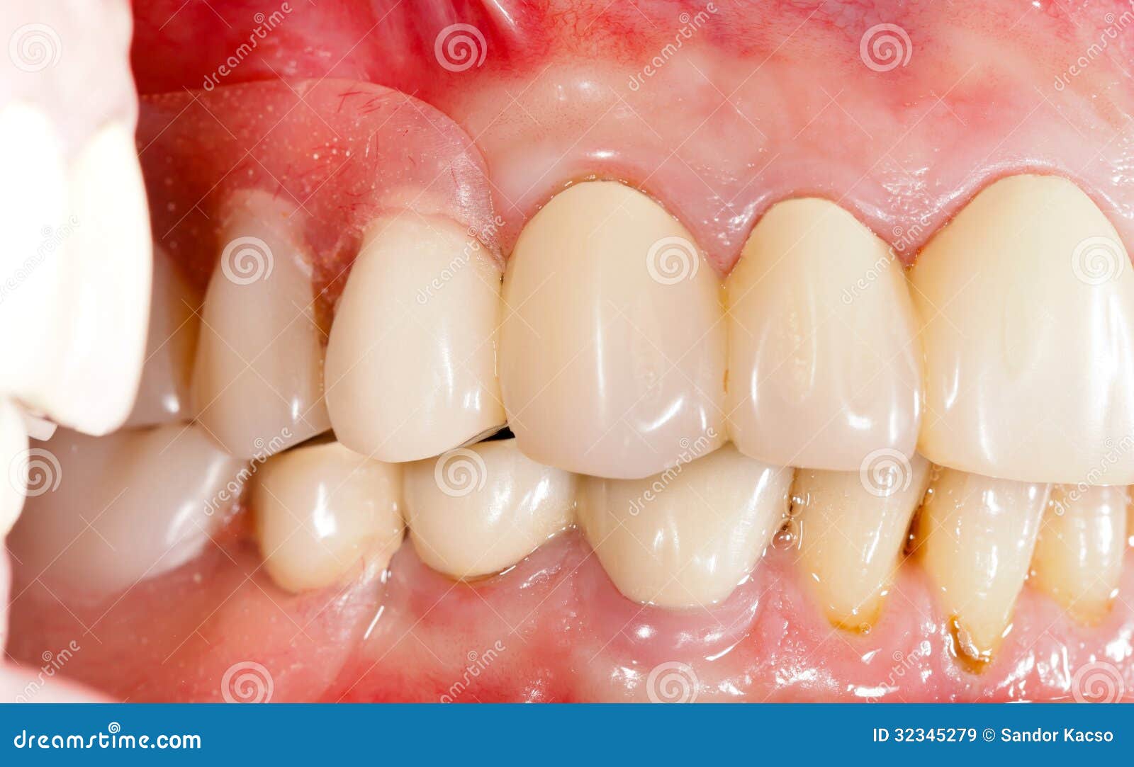 Dental Prosthetics Royalty Free Stock Images - Image: 32345279