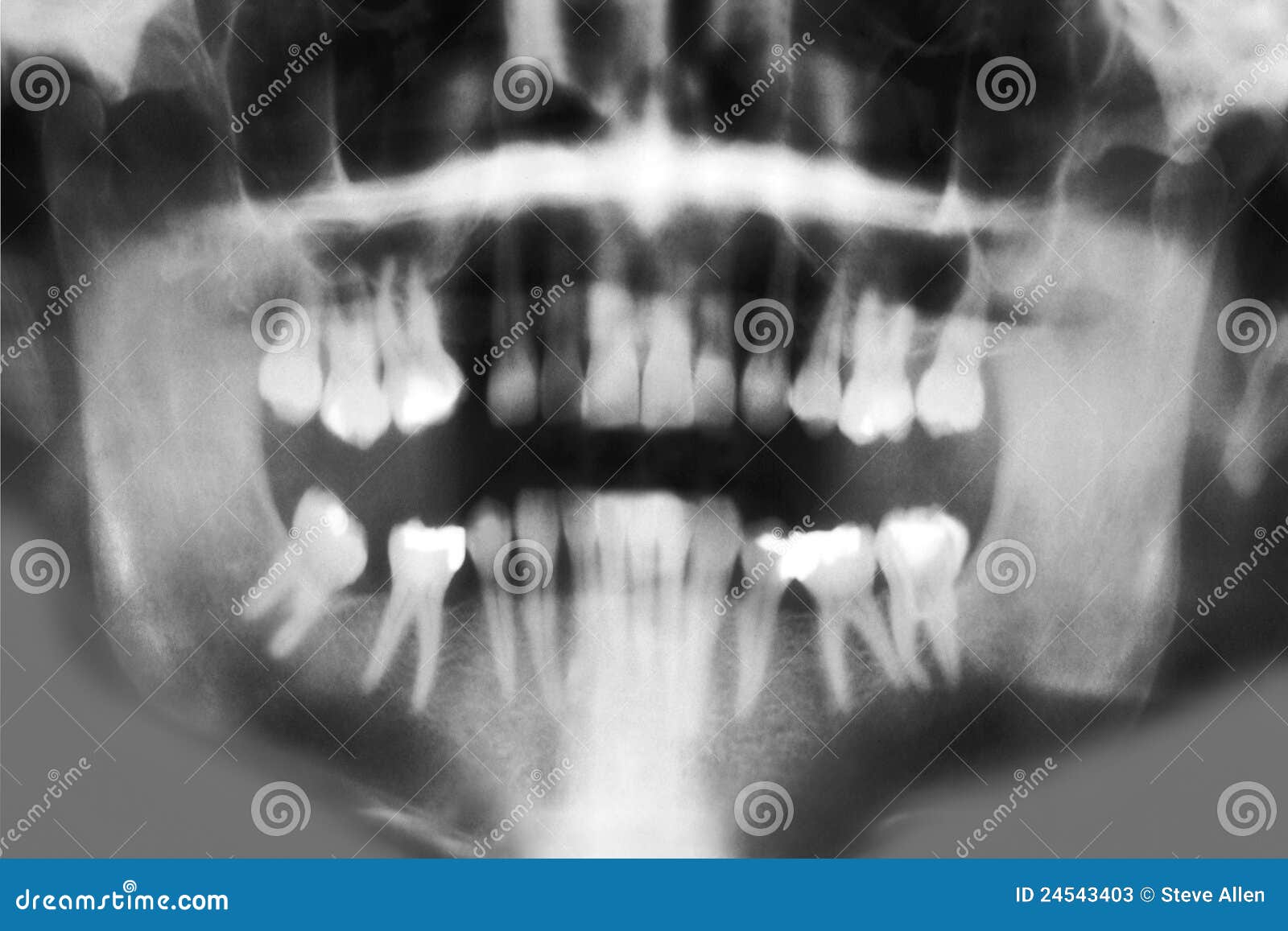 Dental X-Ray - Full Mouth Scan Stock Image - Image of molar, diagnostic ...