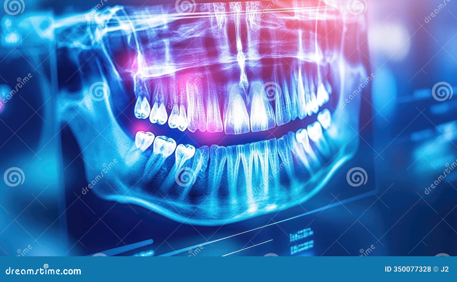 Dental X-ray Image Highlighting Panoramic View of Teeth and Jaw ...