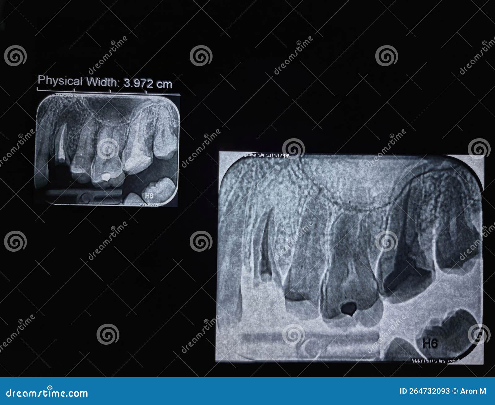 Dental X-ray Image, Teeth X-ray Film Stock Image - Image of dental ...