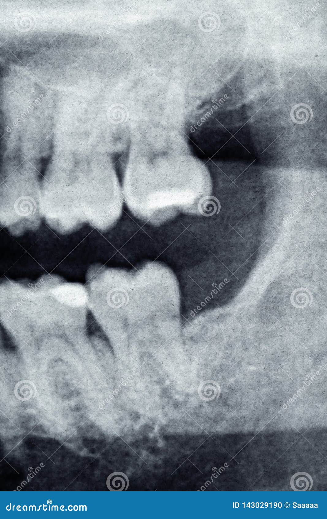 Dental X-Ray or the Left Side of Back Tooth End, Caucasian Man Stock ...