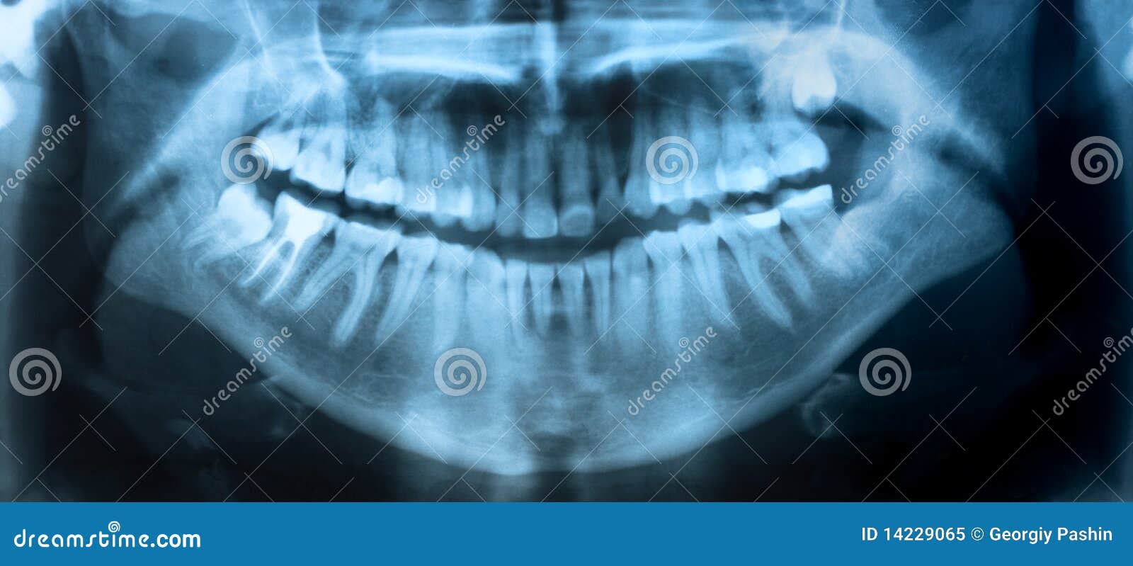Dental X-Ray panoramic stock image. Image of gums, hygiene - 14229065
