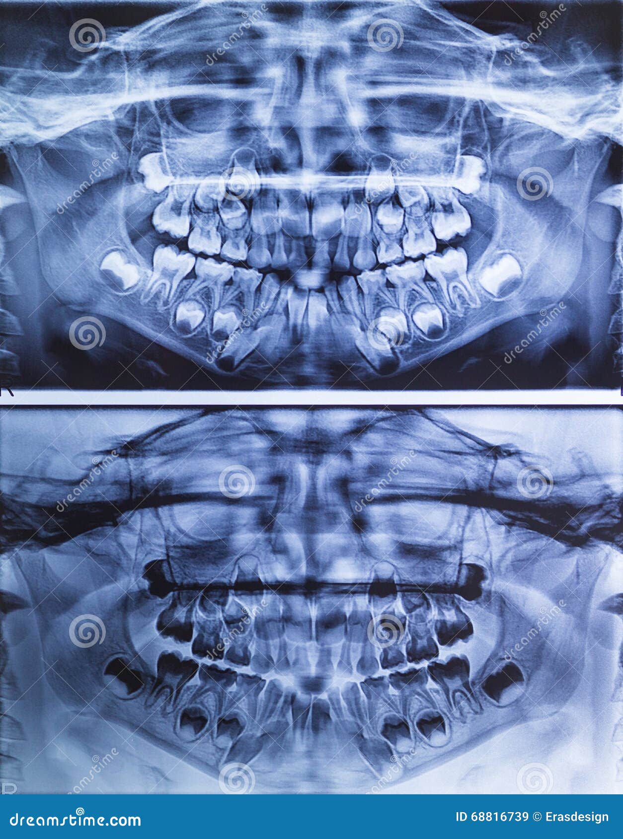 Dental X-Ray Panoramic of Children Stock Image - Image of examination ...