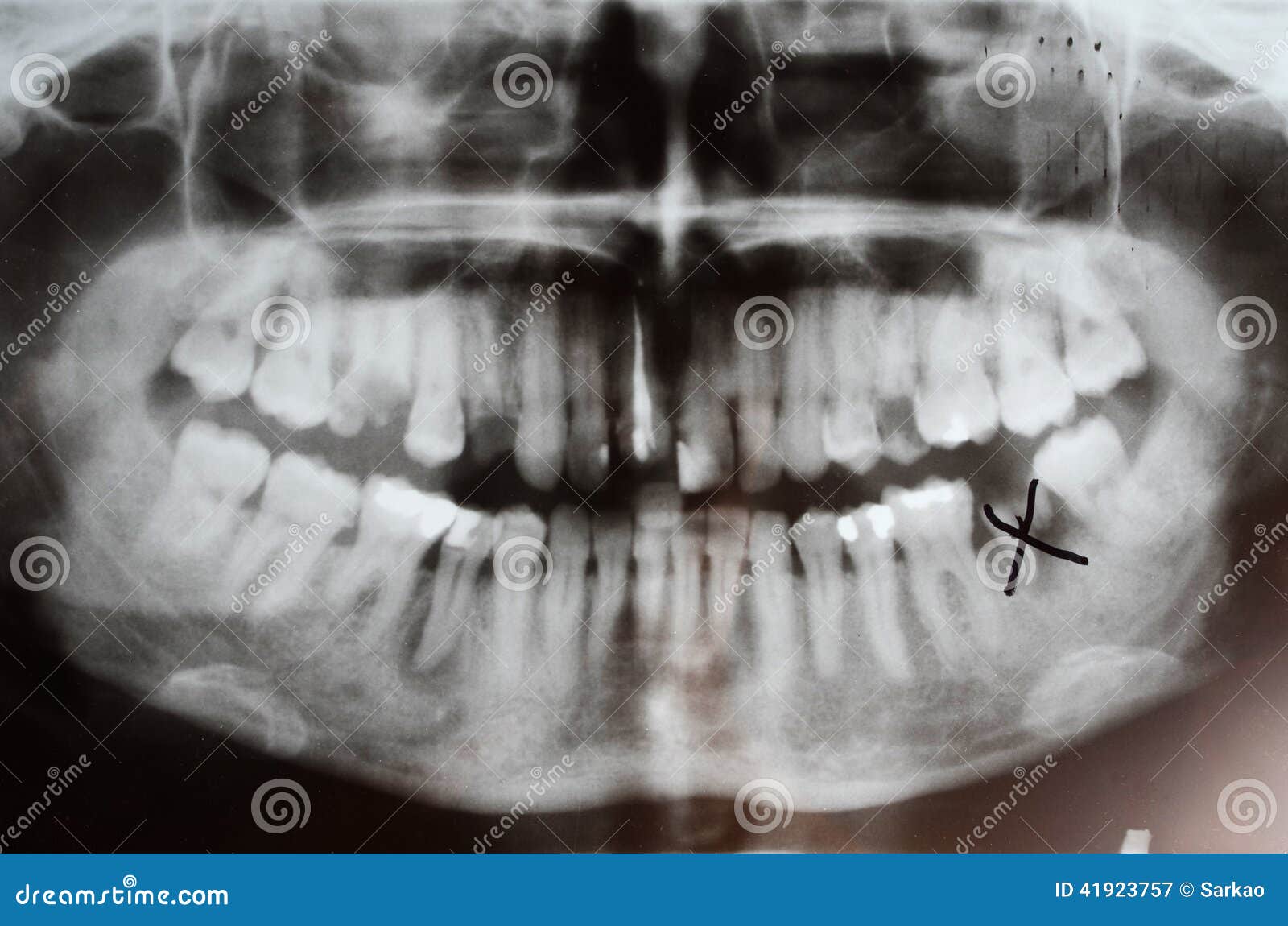 Dental x-ray stock image. Image of orthodontic, diagnosis - 41923757