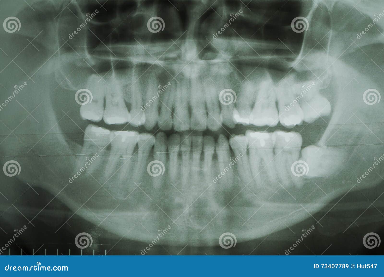 Dental X-Ray. a Panoramic X-ray of a Mouth Stock Image - Image of human ...