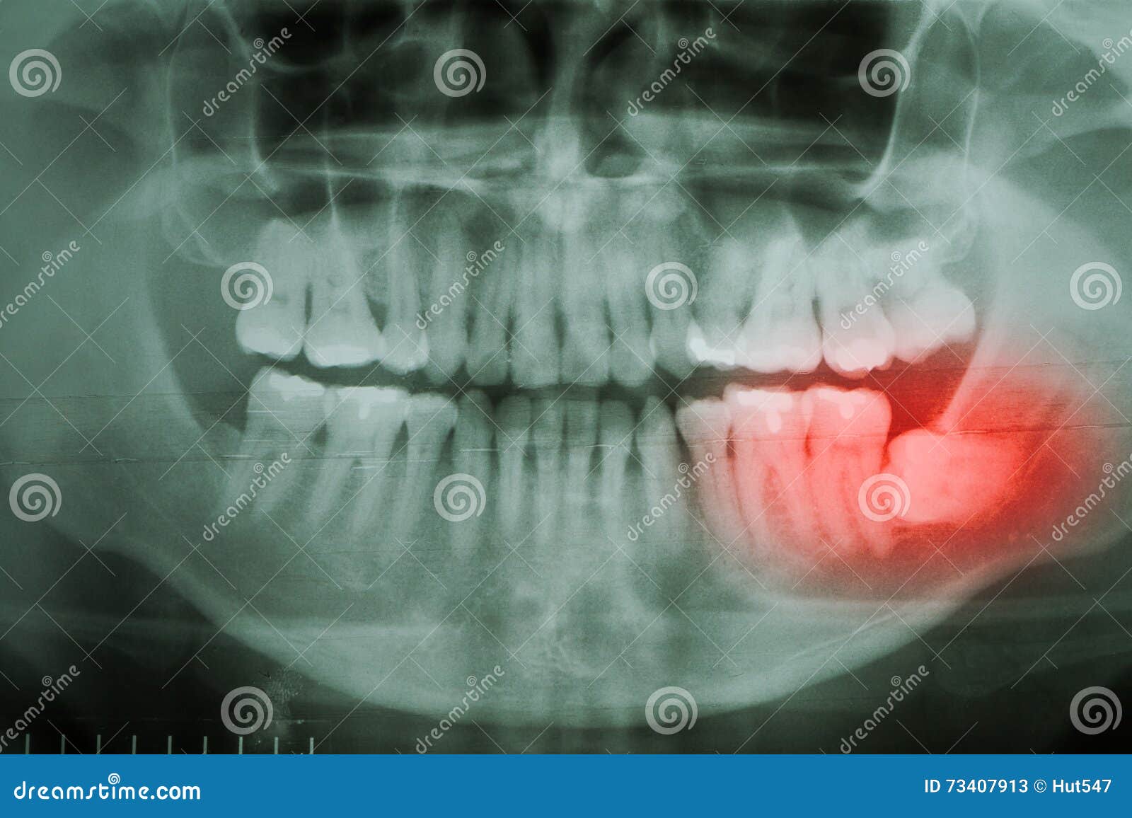 Dental X-Ray. a Panoramic X-ray of a Mouth Stock Image - Image of ...
