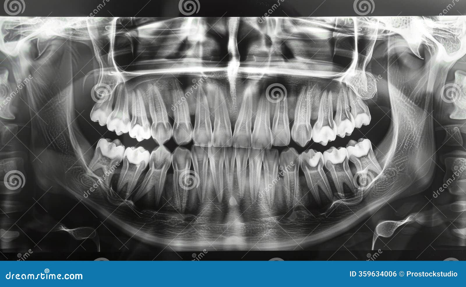 Detailed Dental X Ray Showing Upper and Lower Teeth Alignment Along ...