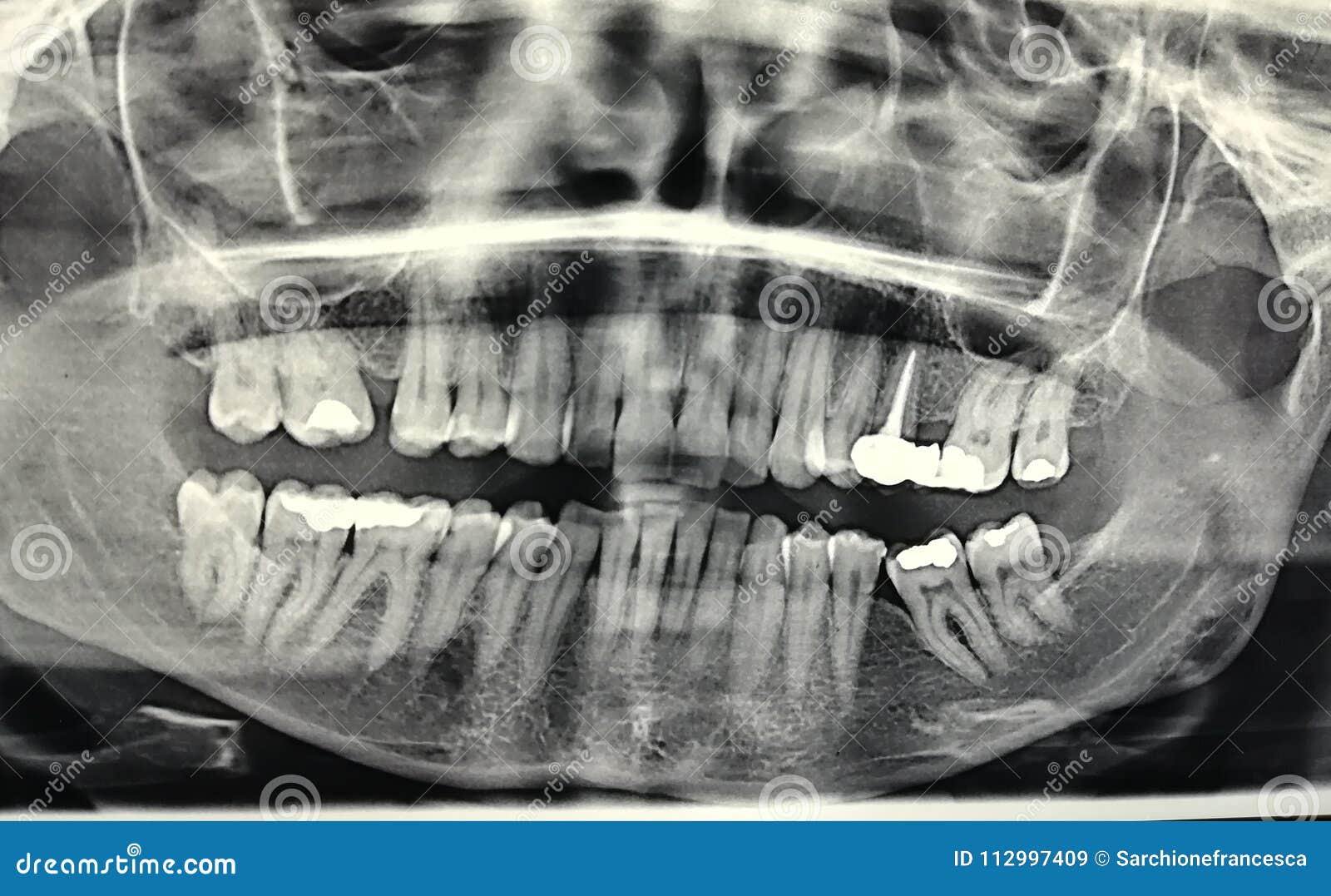 Dental X-ray stock image. Image of dentalxray, toothache - 112997409