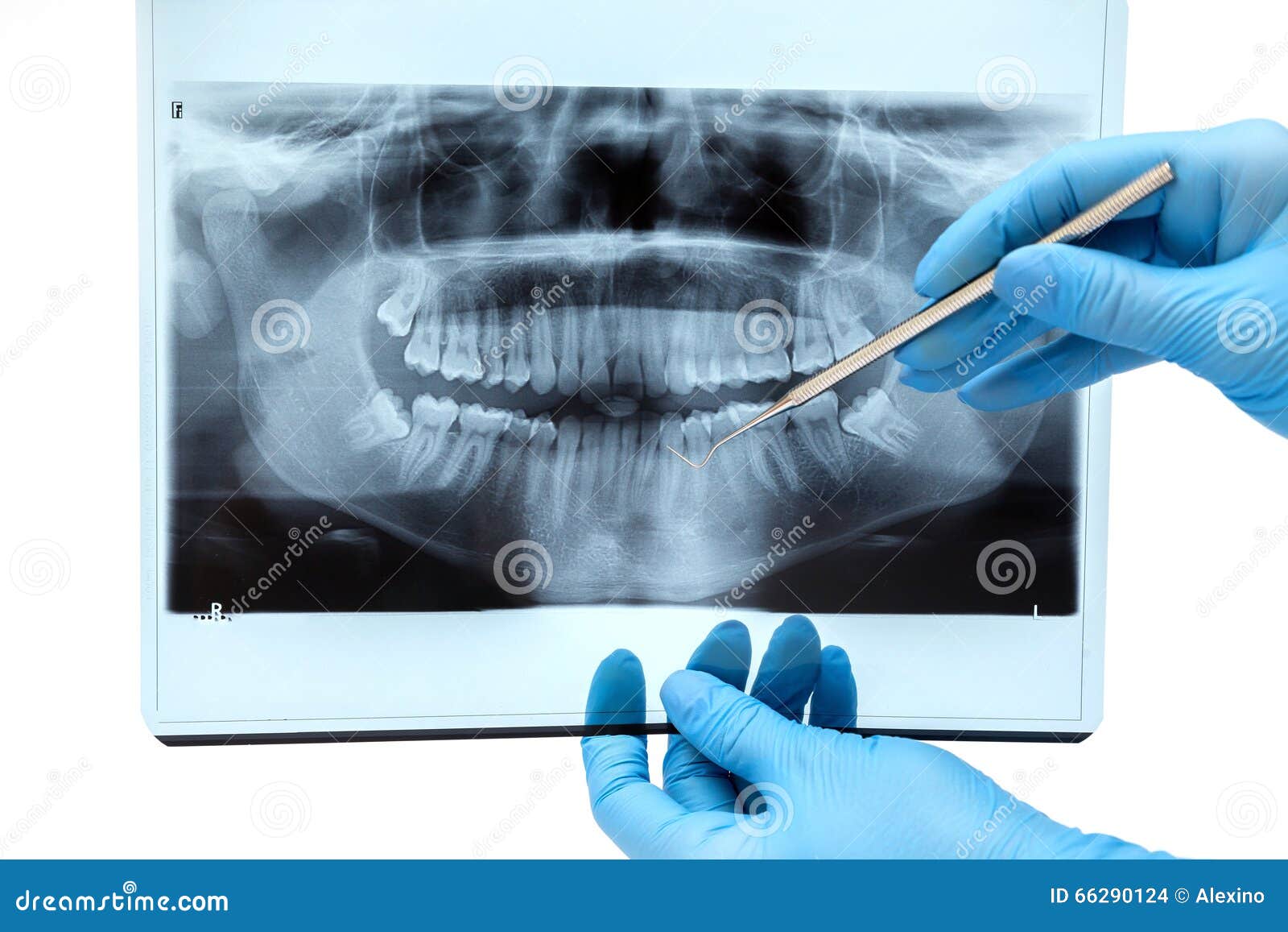 Dental X-ray stock photo. Image of healthcare, denture - 66290124