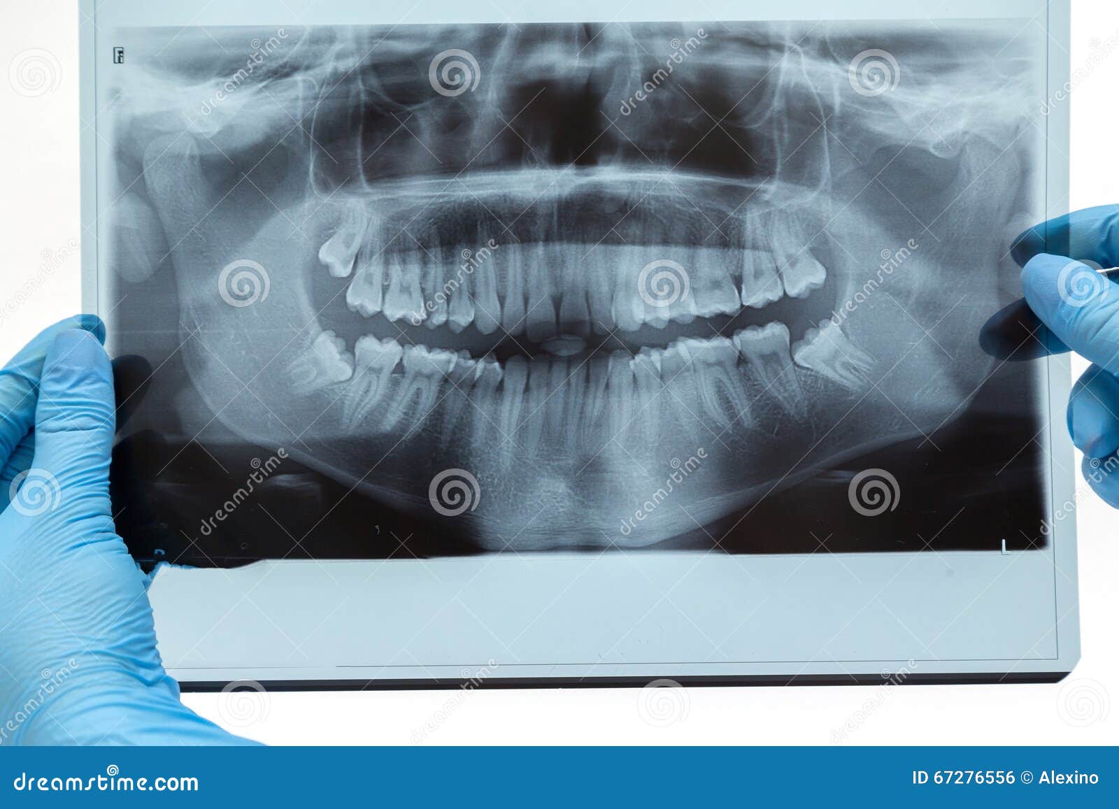 Dental X-ray. Radiography stock photo. Image of denture - 67276556