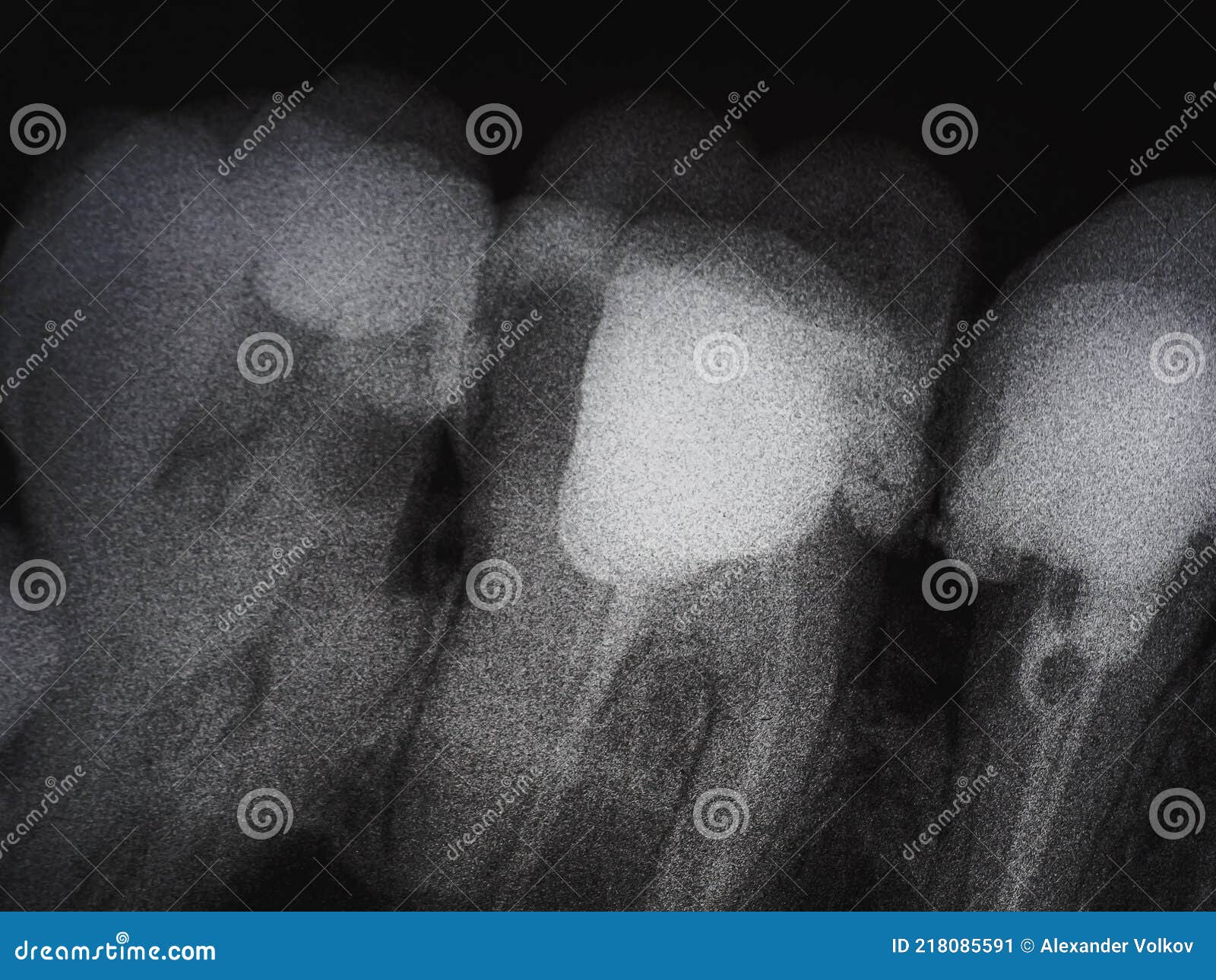 Dental X-ray of Several Bad Molars. Caries Stock Image - Image of sick ...