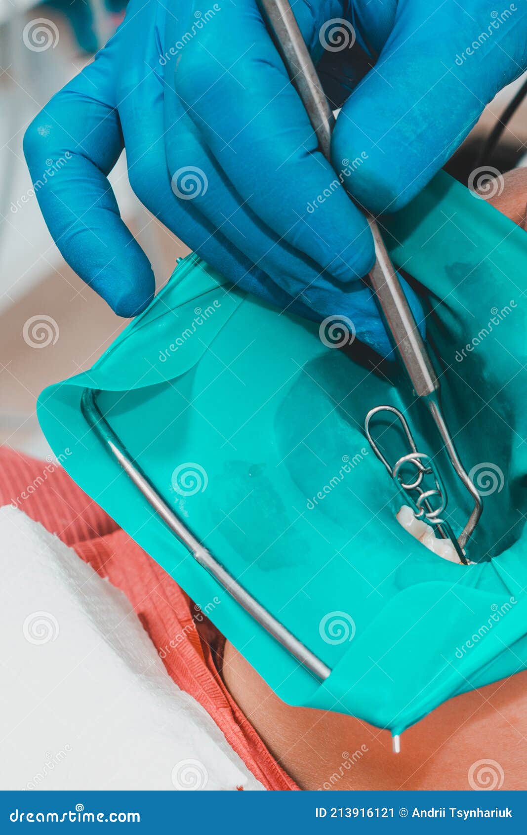 Dental Restoration and Polymerization of Tooth Composite Materials, the ...