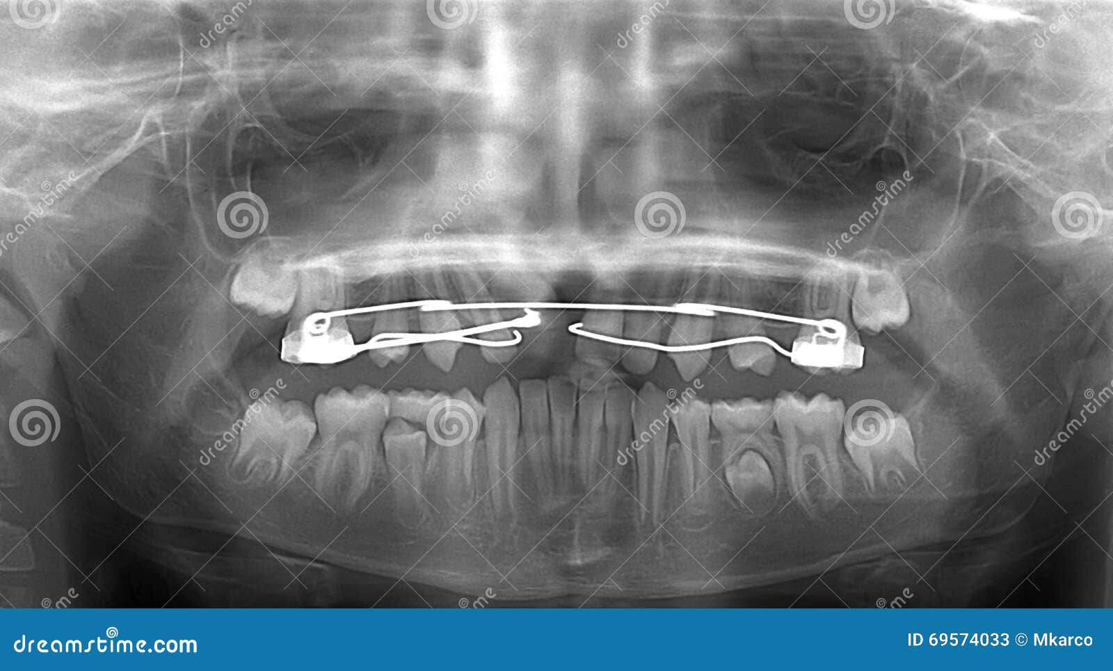 Dental Scan with Fixed Appliance Stock Image - Image of smile ...