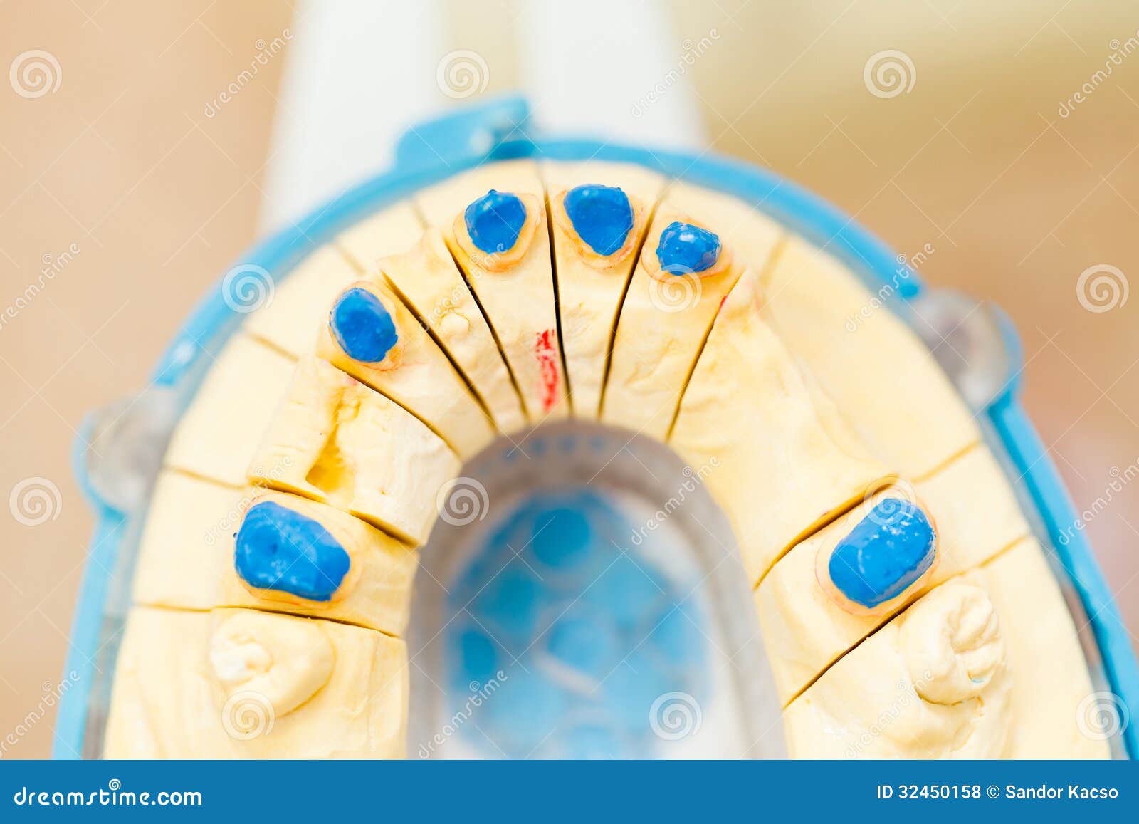 Dental Stumps - Gypsum Model Stock Photo - Image of human, technician ...