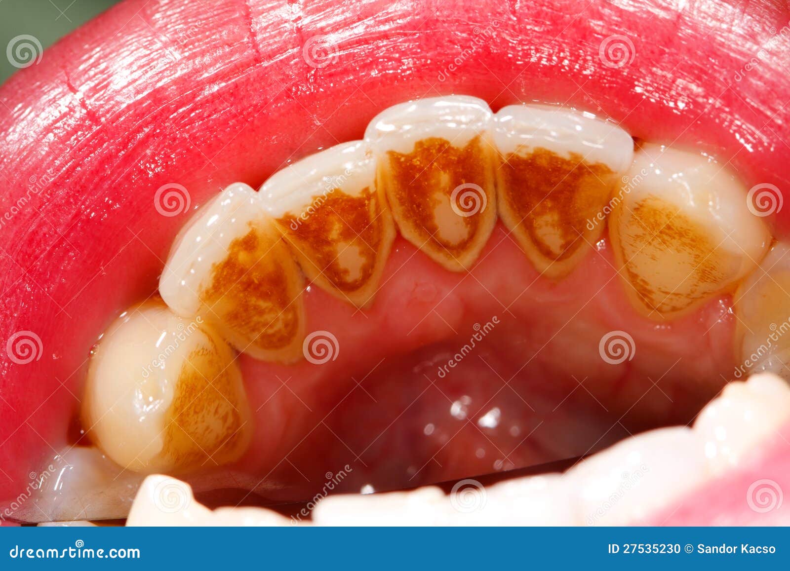 Dental plaque closeup stock photo. Image of health, inflammation - 27535230