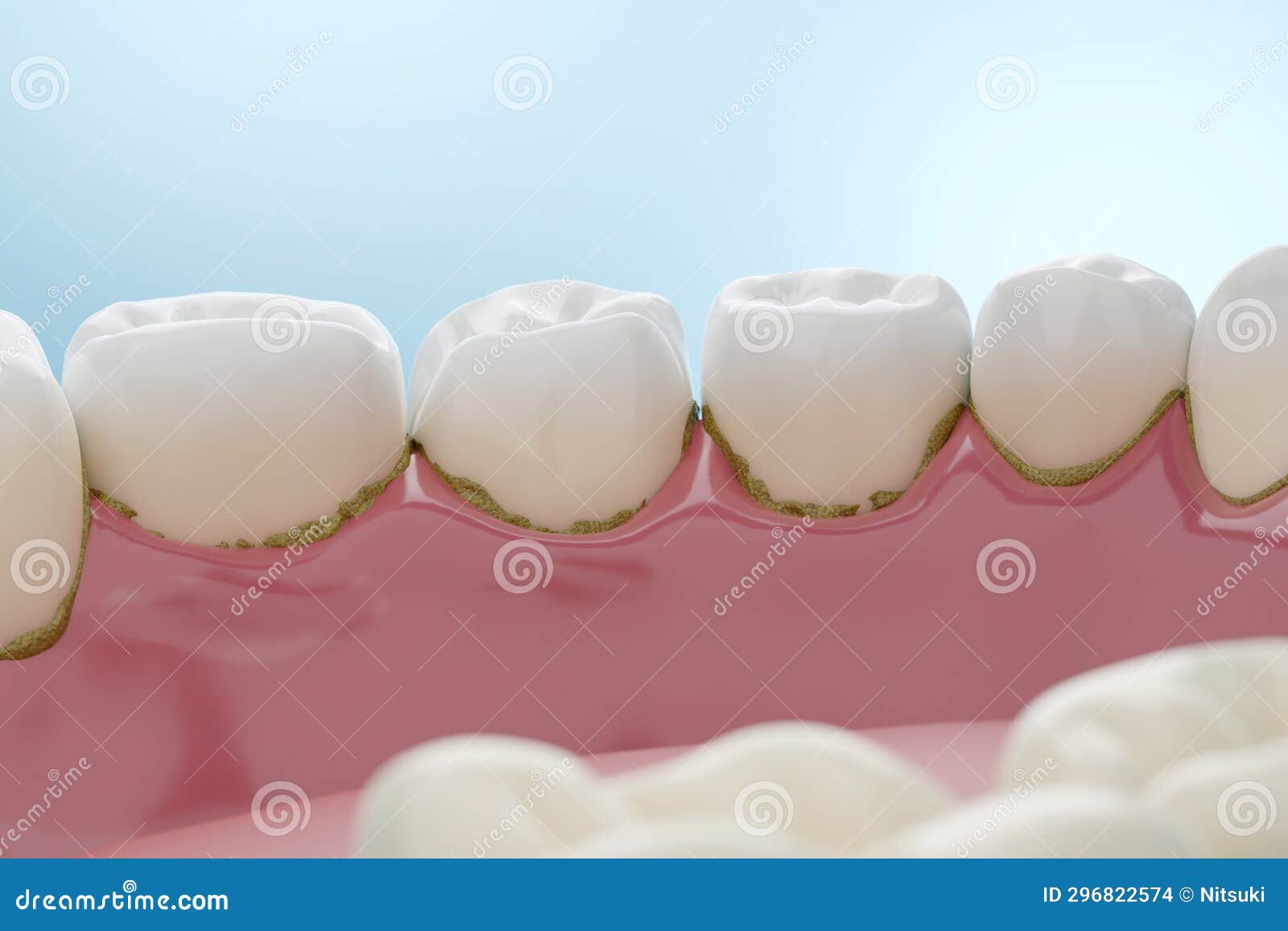 Dental Tartar at Molar Teeth for Tartar and Tooth Plaque Removal Stock ...