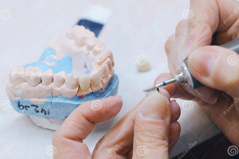 A Dental Technician Cleans Dentures with a Milling Cutter in the ...