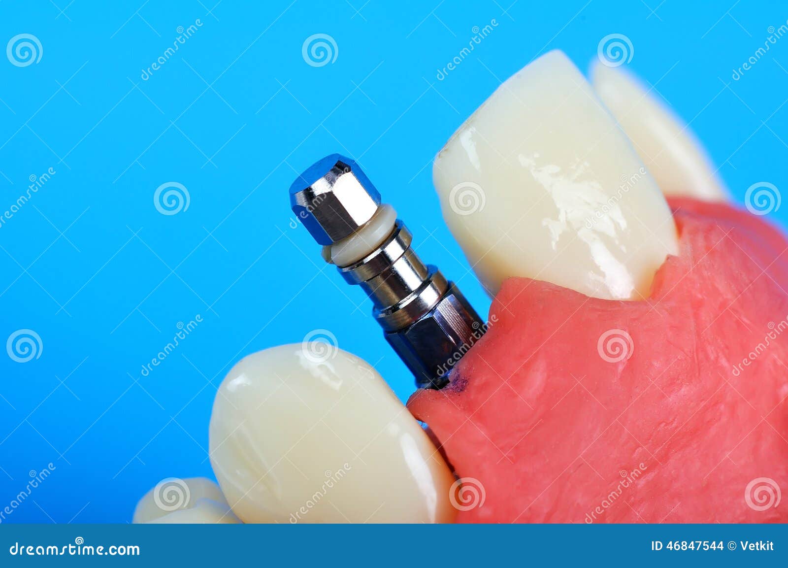 Dental titanium implant stock photo. Image of artificial - 46847544