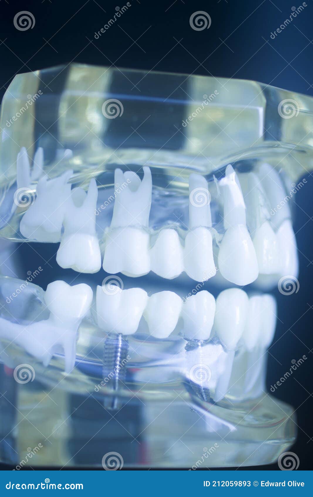 Dental tooth implant model stock image. Image of gums - 212059893