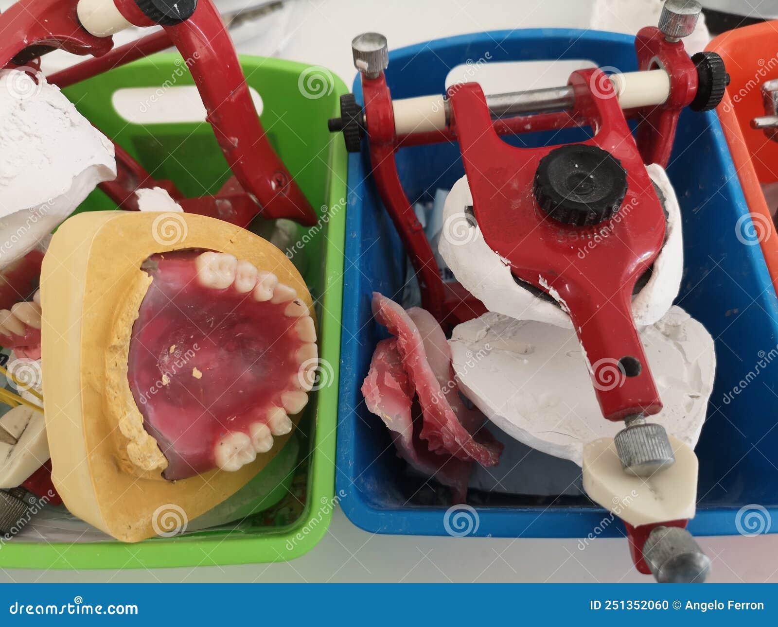 Dental Work Cast Denture Construction- Stock Photo - Image of model ...