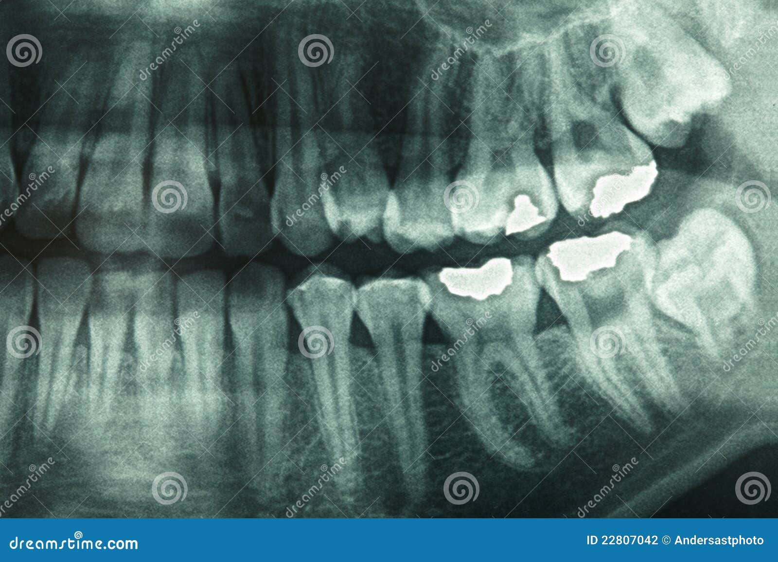Dental xray stock photo. Image of operation, radiation - 22807042