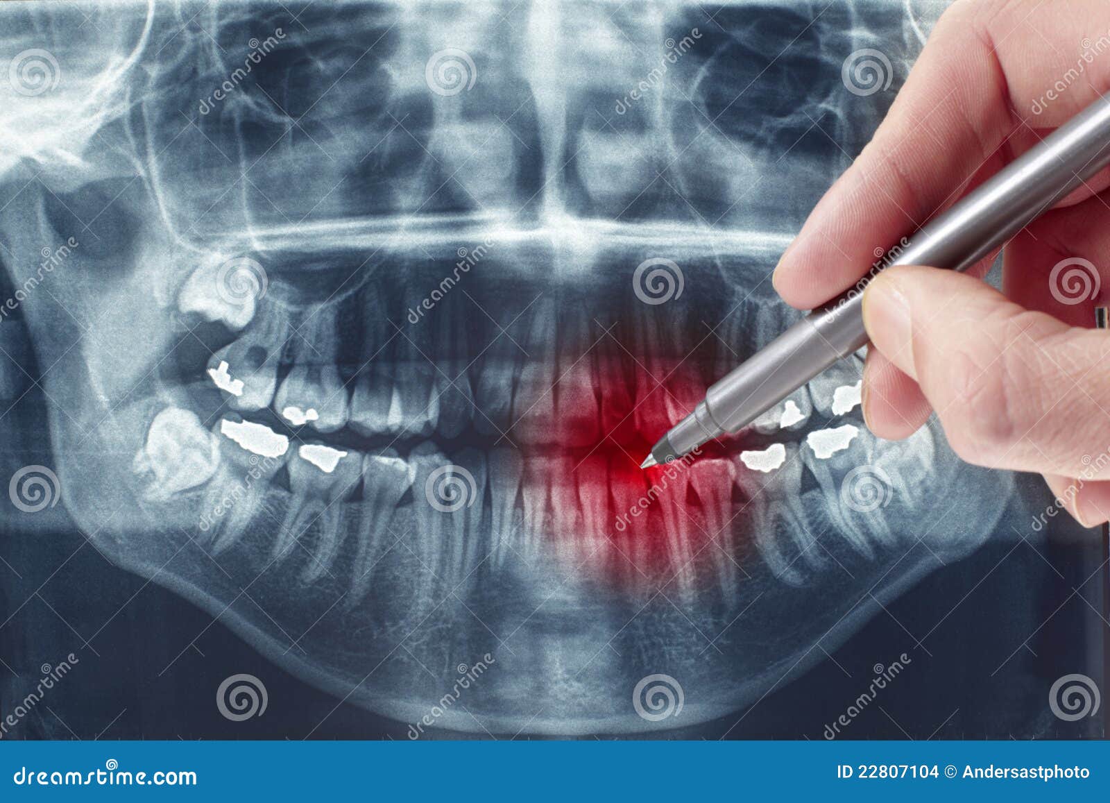 Dental xray stock photo. Image of exam, dentistry, clinic - 22807104