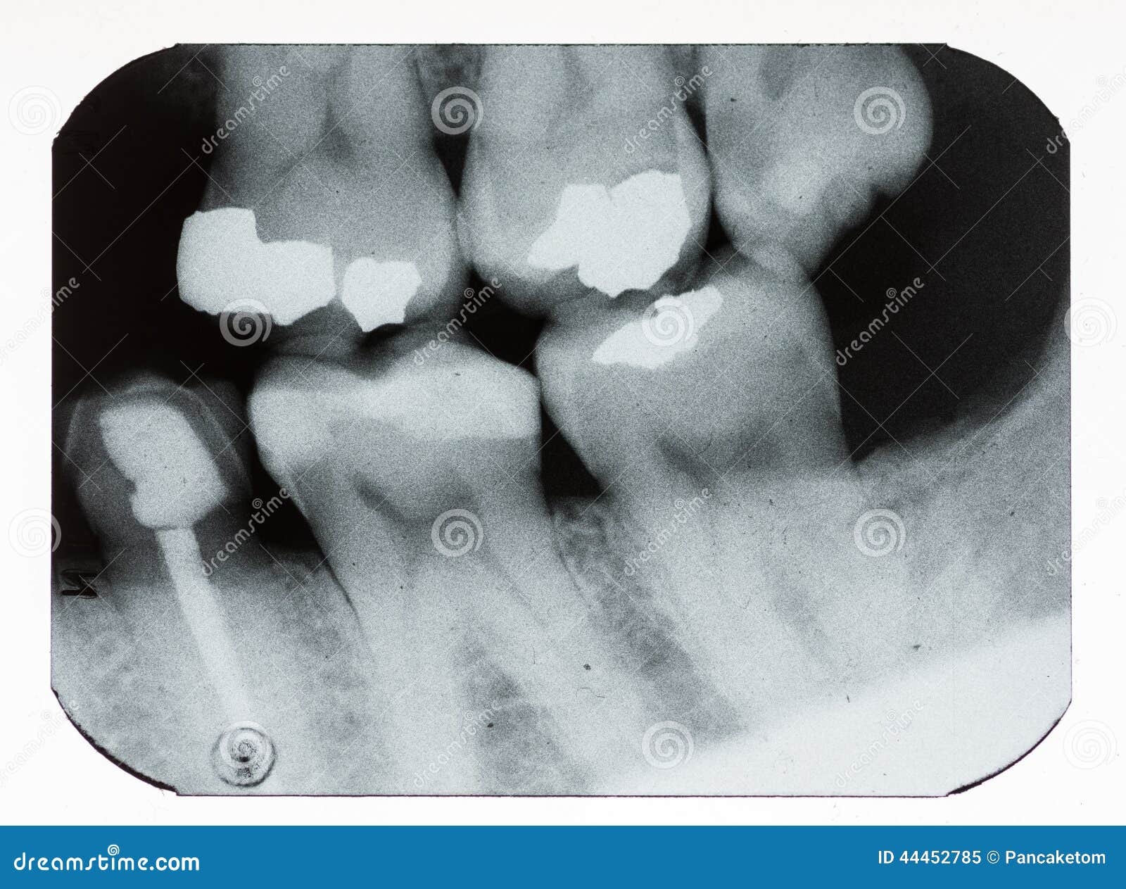 Dental xray stock image. Image of implant, teeth, missing - 44452785
