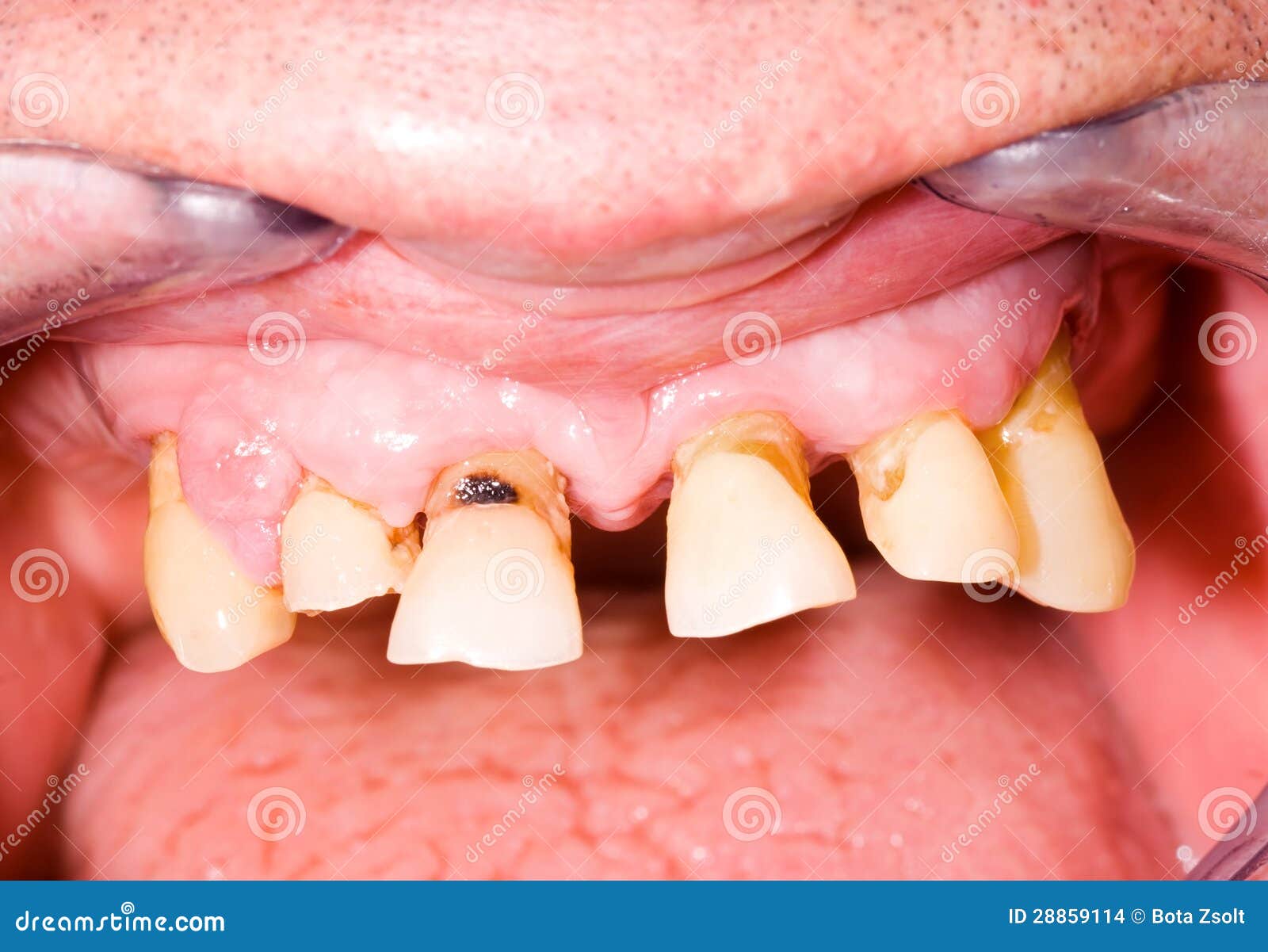 Dentes frontais foto de stock. Imagem de peridental, cuidado - 28859114