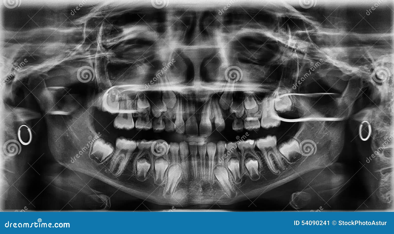Denti della radiografia immagine stock. Immagine di medico - 54090241