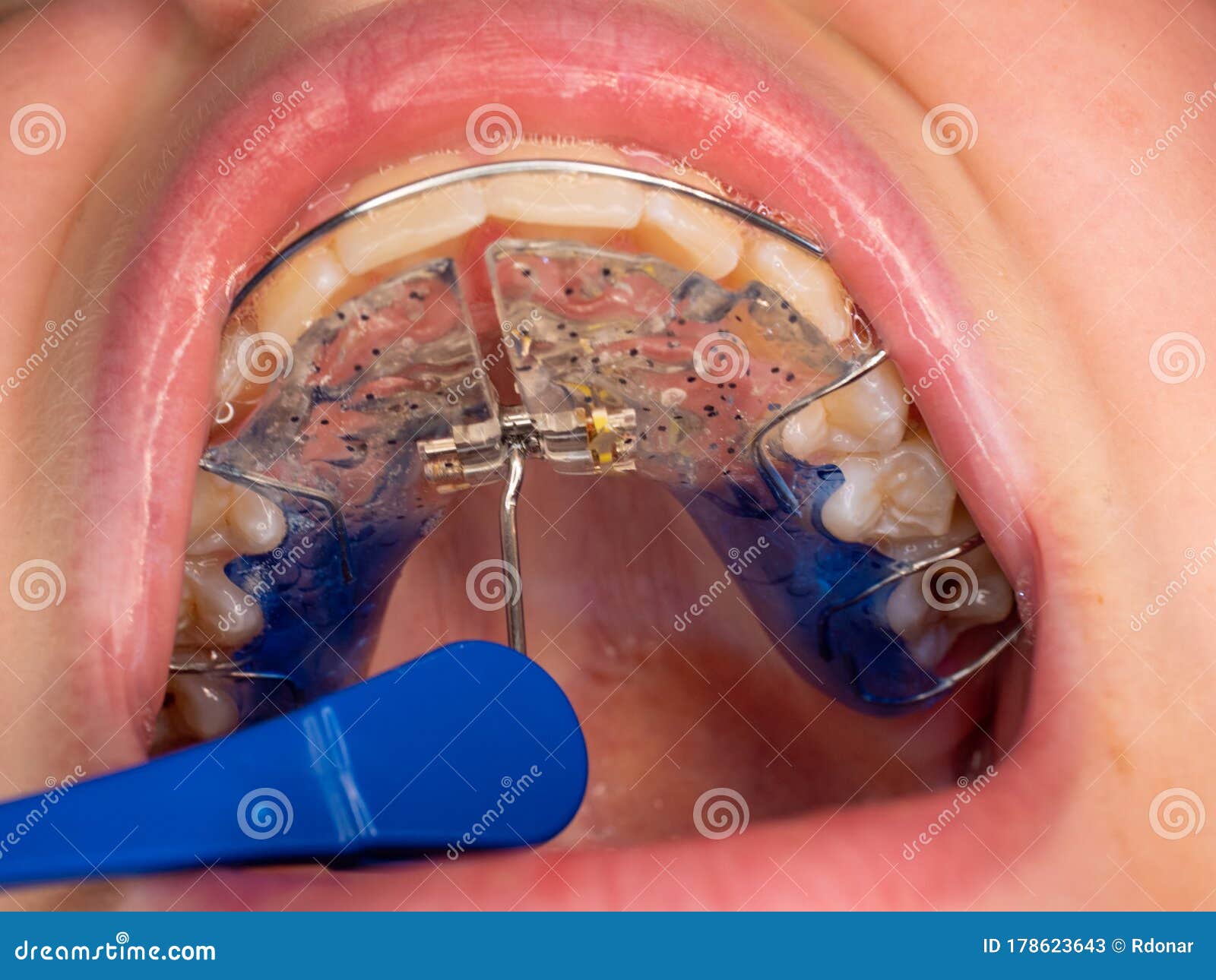 Dentist Check Up Teeth with Expander Brackets Stock Image - Image of ...