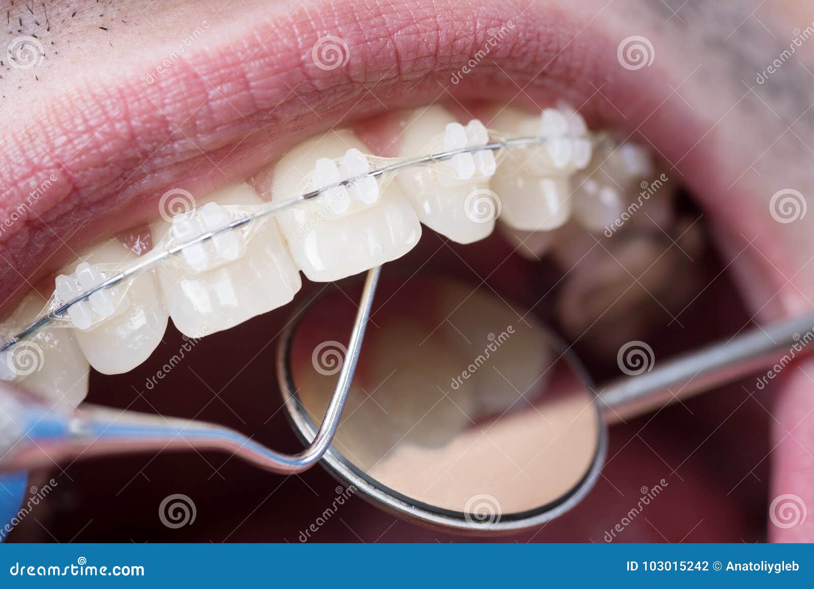 Dentist Checking Up Teeth with Ceramic Brackets Using Dental Tools ...
