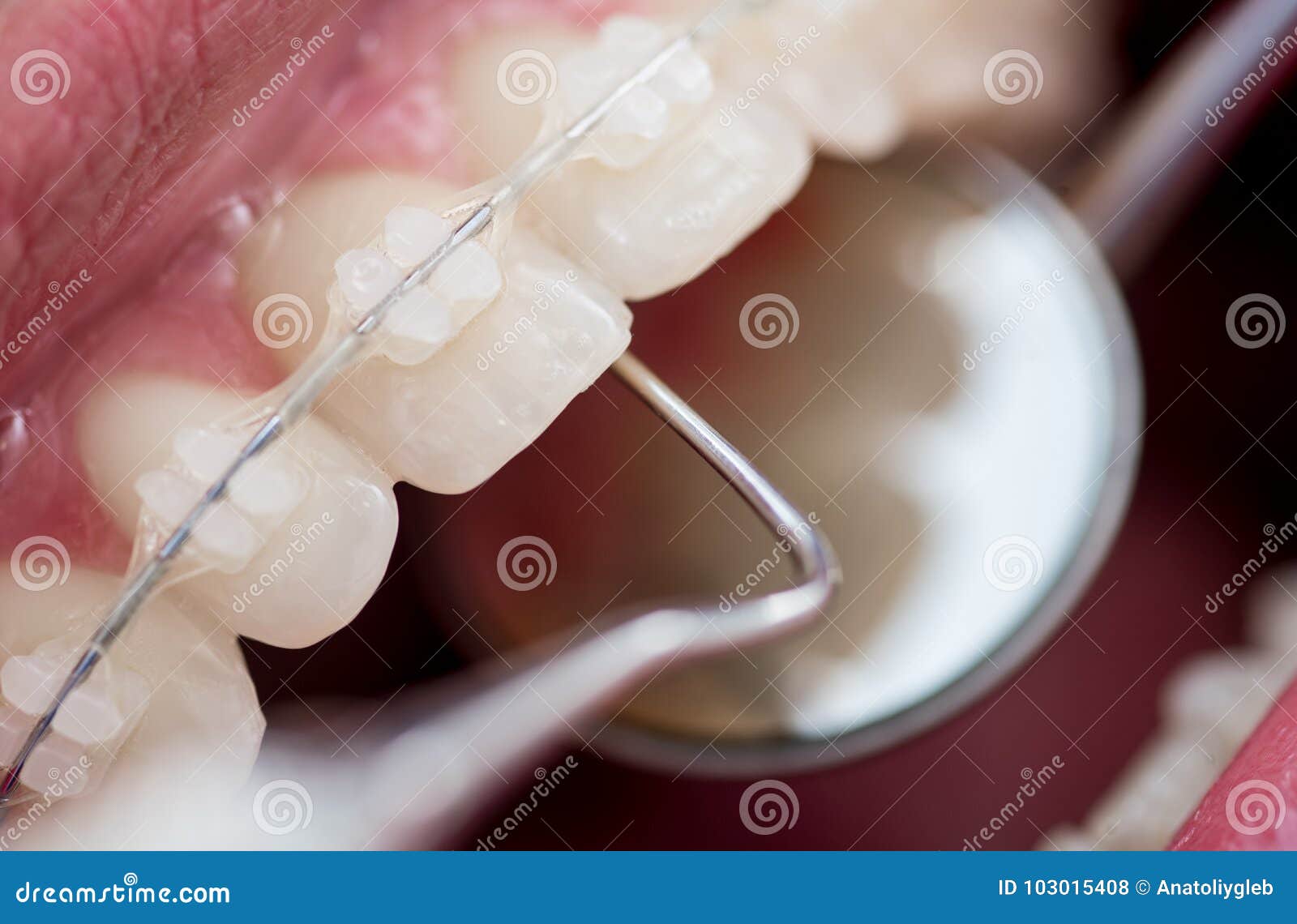 Dentist Checking Up Teeth with Ceramic Brackets Using Dental Tools ...