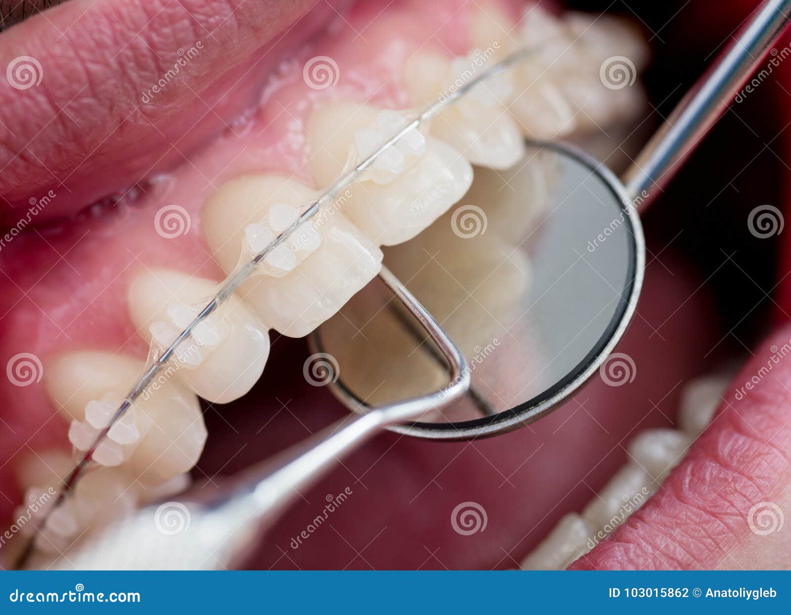 Dentist Checking Up Teeth with Ceramic Brackets Using Dental Tools ...