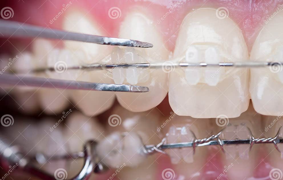 Dentist Checking Up Teeth with Ceramic Brackets, Using Reverse Tweezers ...