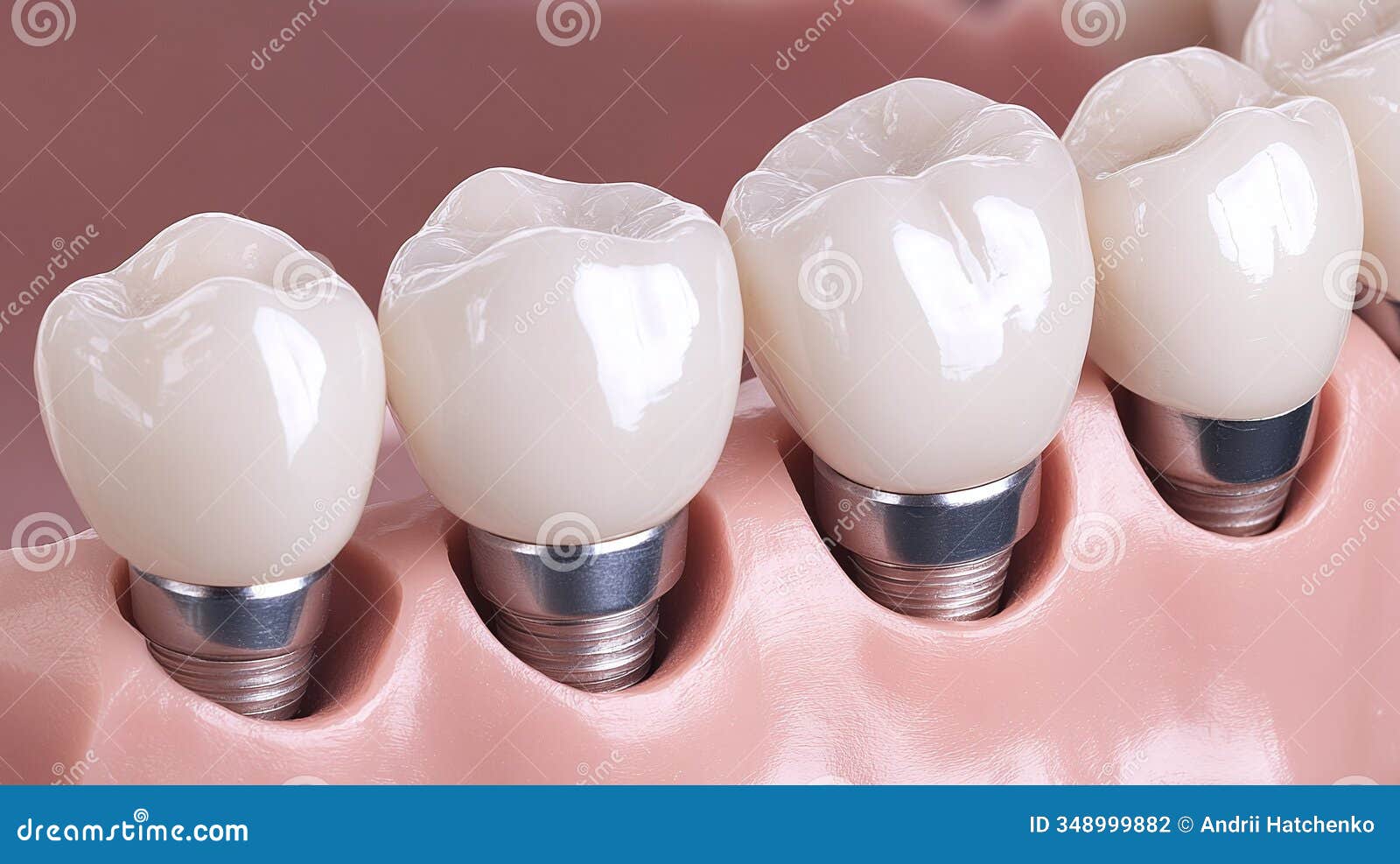 A Dentist Explaining the Function of a Dental Bridge Using a Tooth ...